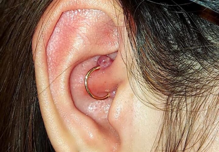 Why You’re Getting a Piercing Bump — And What Actually Helps It Go Away